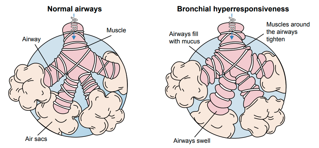 Asthma in elite athletes - European Lung Foundation