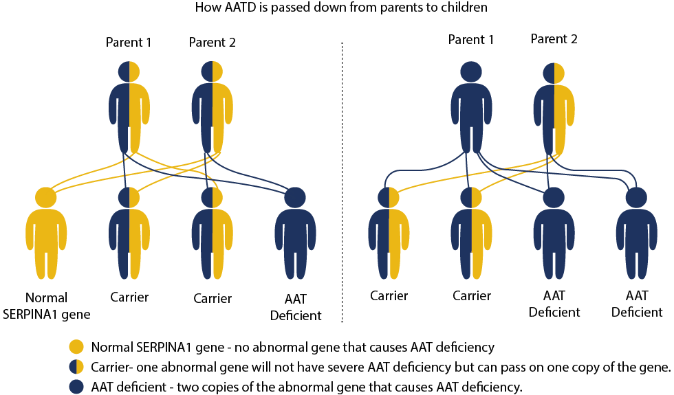Alpha-1 antitrypsin deficiency - European Lung Foundation