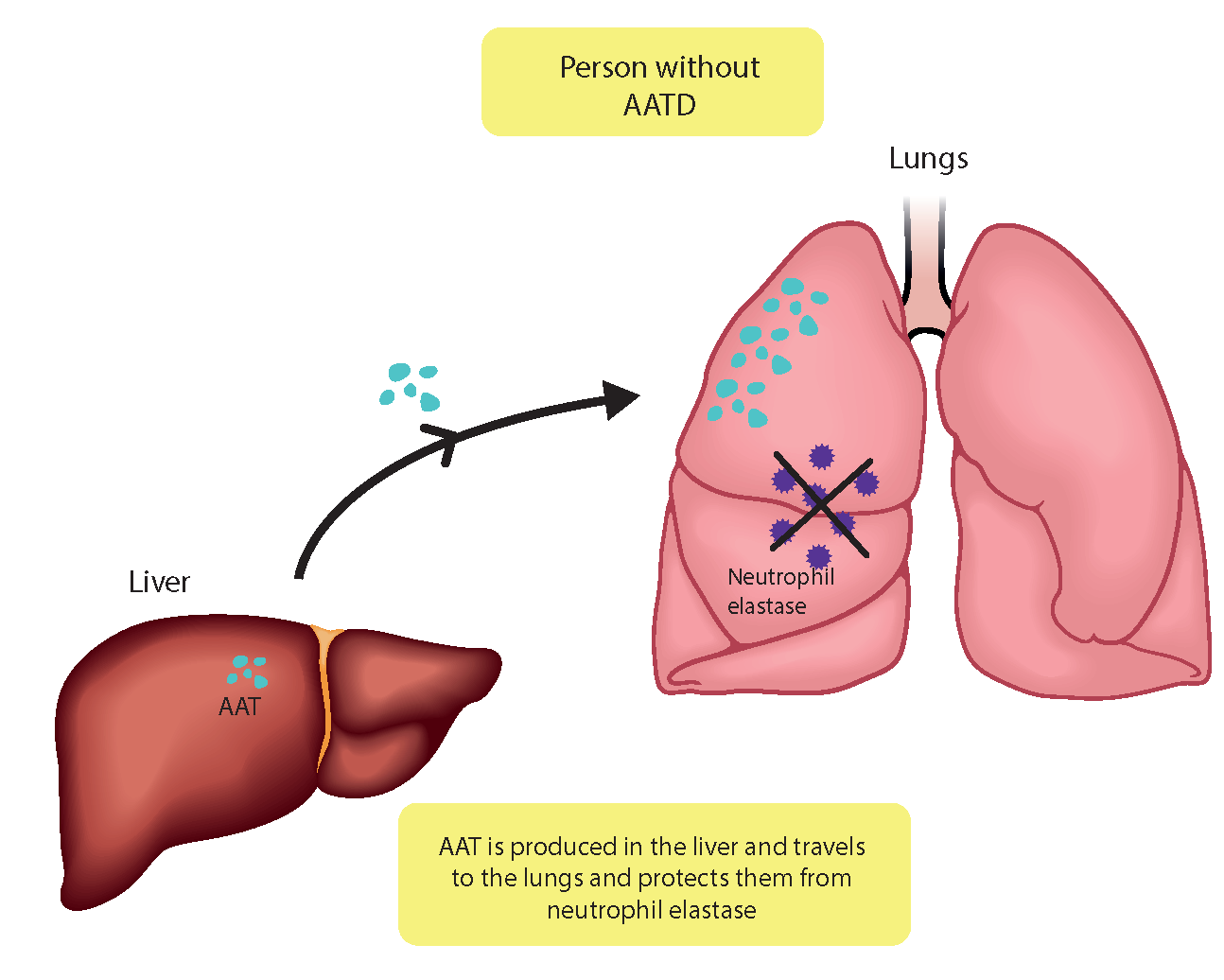Alpha 1 Antitrypsin Deficiency European Lung Foundation