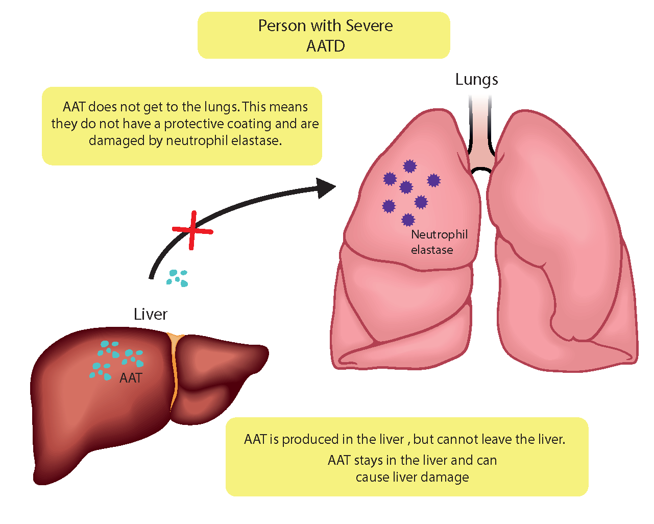 Alpha-1 antitrypsin deficiency - European Lung Foundation