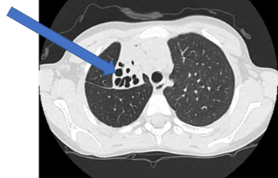 Diagnosing and treating non-cystic fibrosis bronchiectasis in children ...